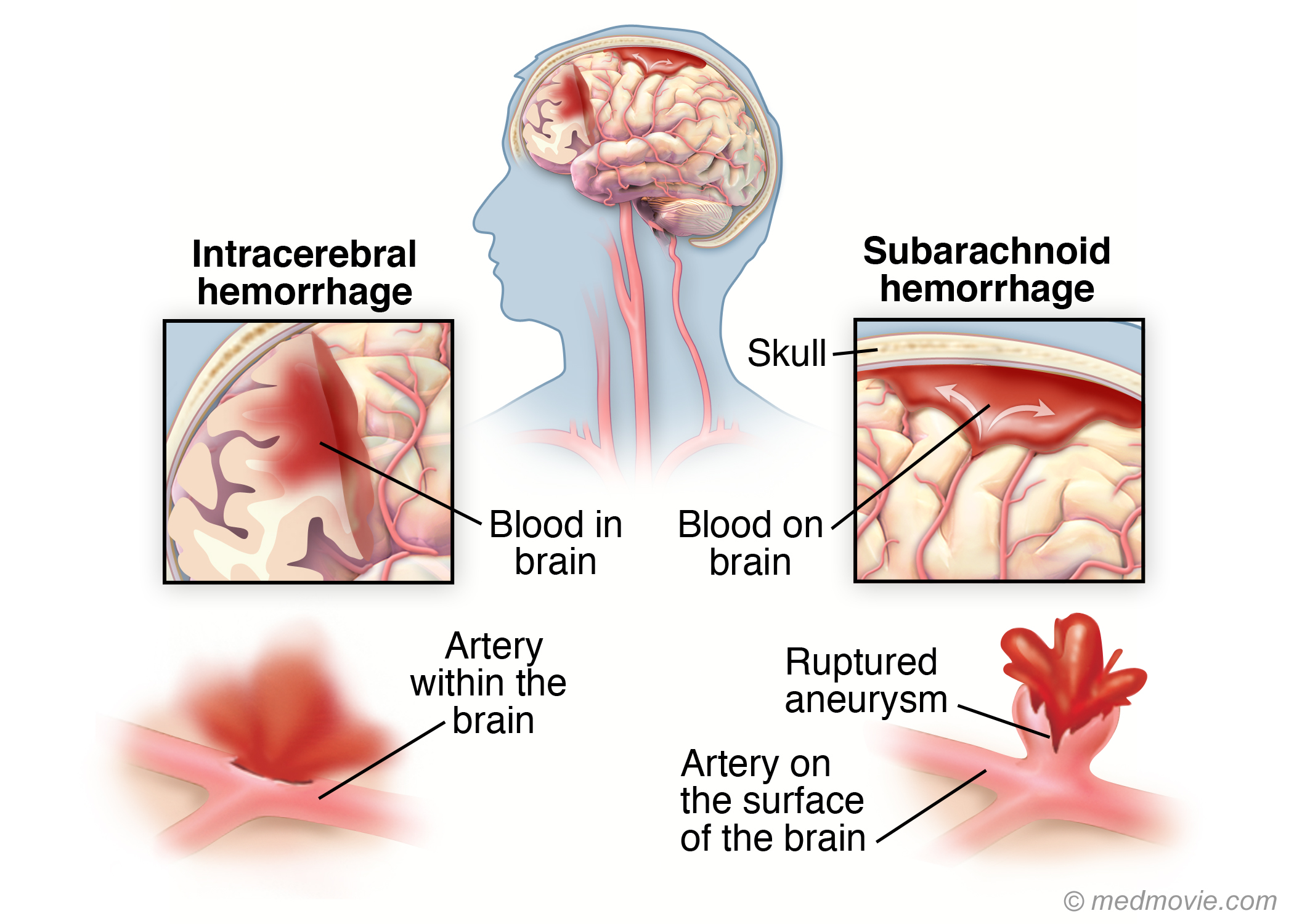 Medmovie Types Of Hemorrhagic Stroke Medmovie Types Of Hemorrhagic Stroke