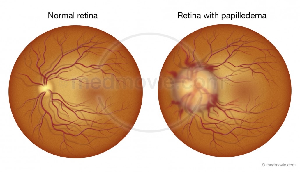 Papilledema Choked Disk Optic Papilla Edema Optic Disk Edema Papilledema Choked Disk Optic Papilla Edema Optic Disk Edema