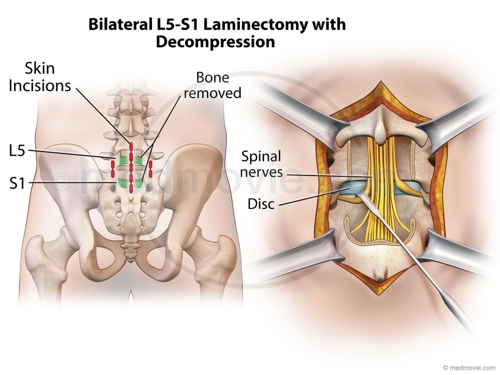 Laminectomy Laminectomy