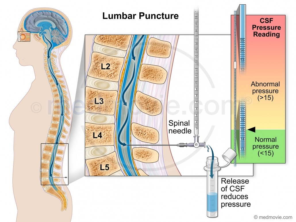 Lumbar Puncture Medmovie