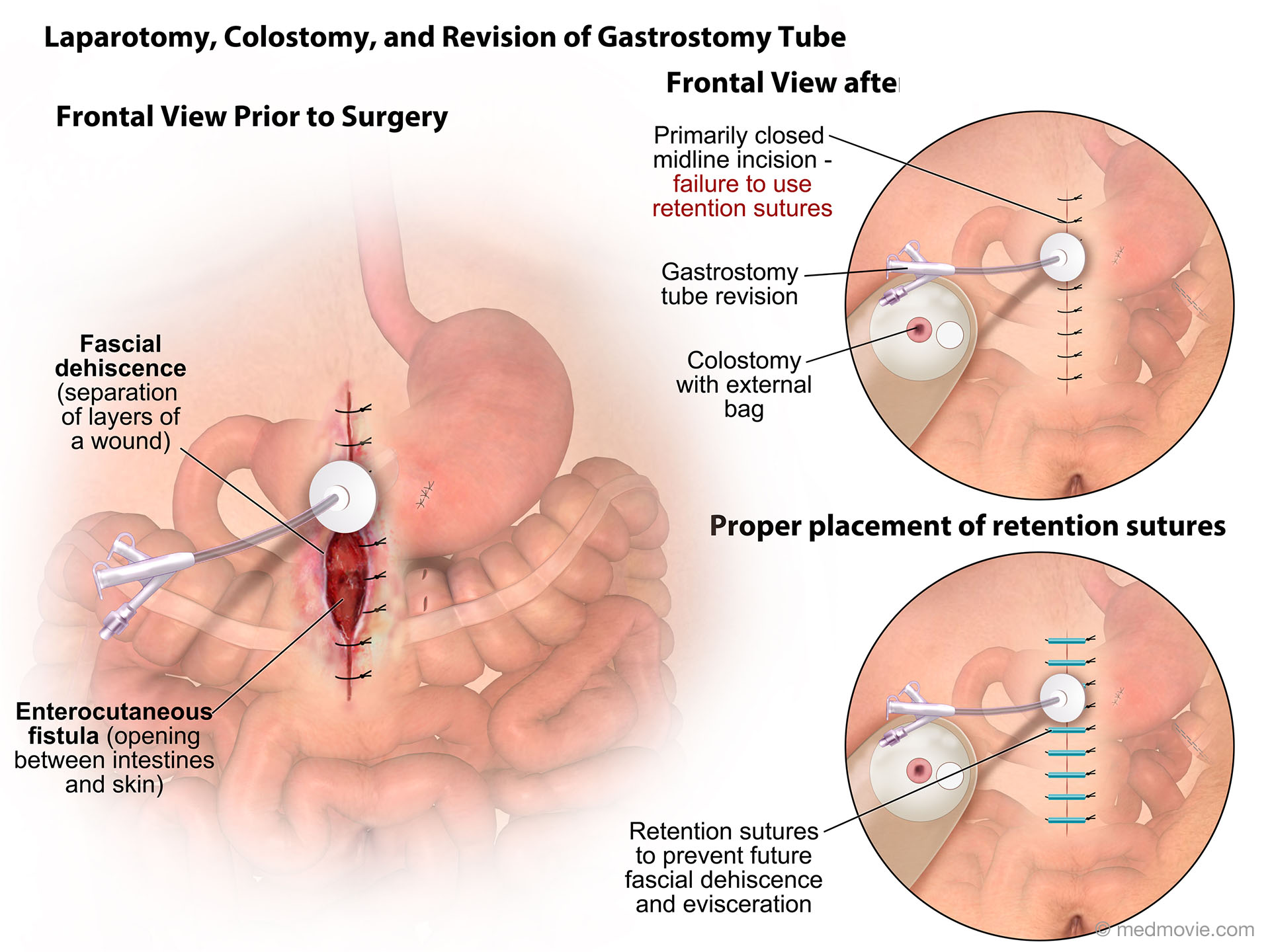 Laparotomy Colostomy And Revision Of Gastrotomy Tube Medmovie Laparotomy Colostomy And Revision Of Gastrotomy Tube Medmovie