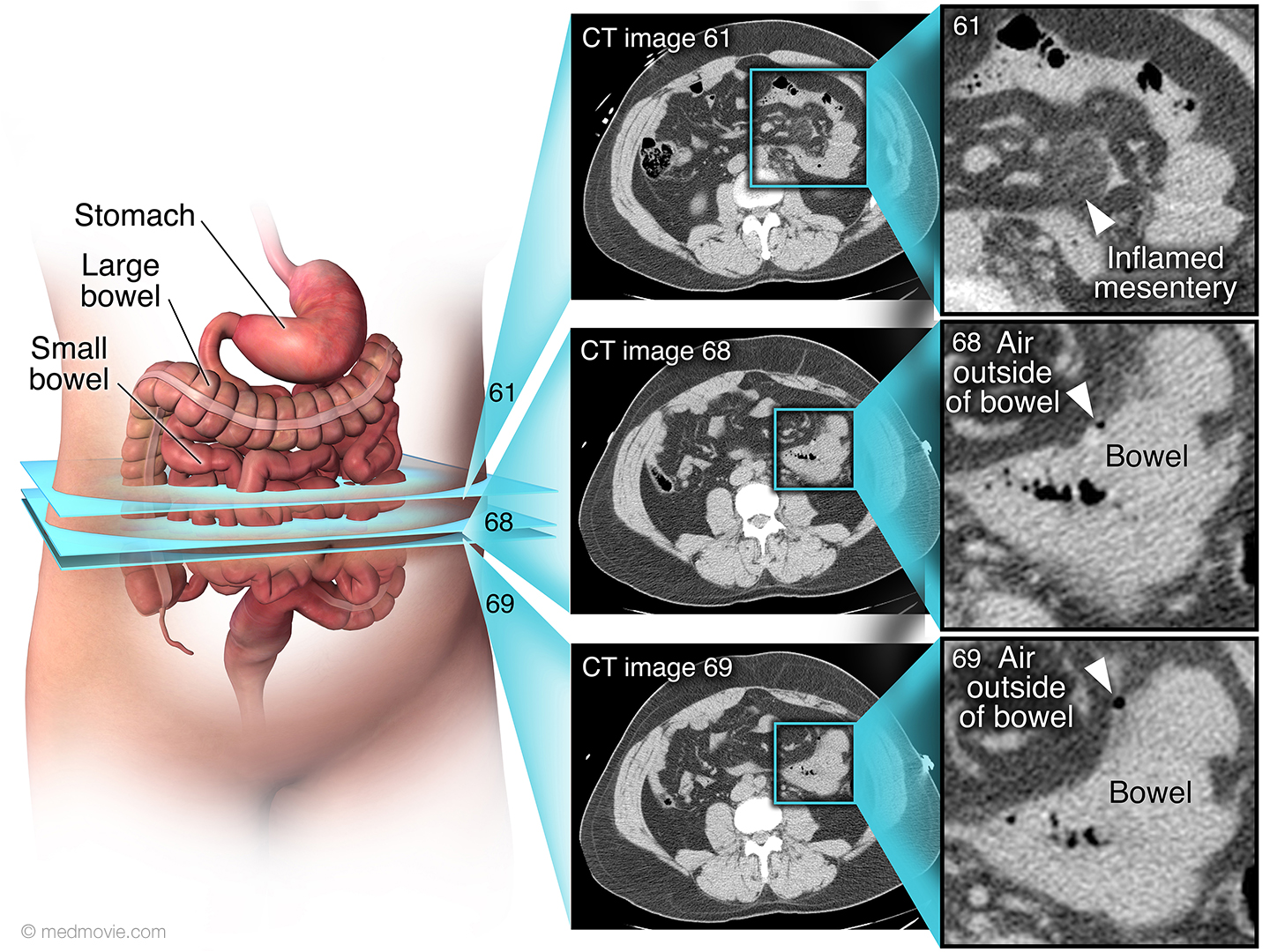 Misdiagnosed Perforated Bowel – Medmovie.com