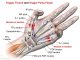 Tendon Rupture Following Trigger Finger Release – Medmovie.com