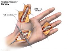 Tendon Rupture Following Trigger Finger Release – Medmovie.com