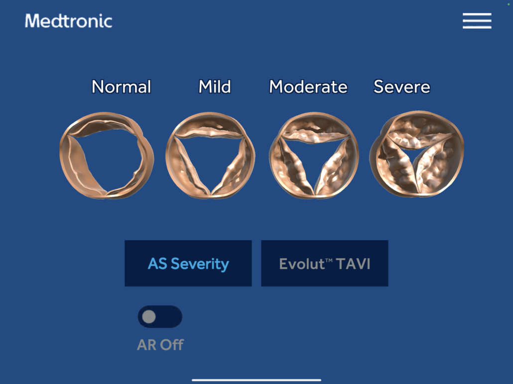 Medtronic U.S. Launches AS TAVR App Powered by Medmovie’s Hx Platform ...