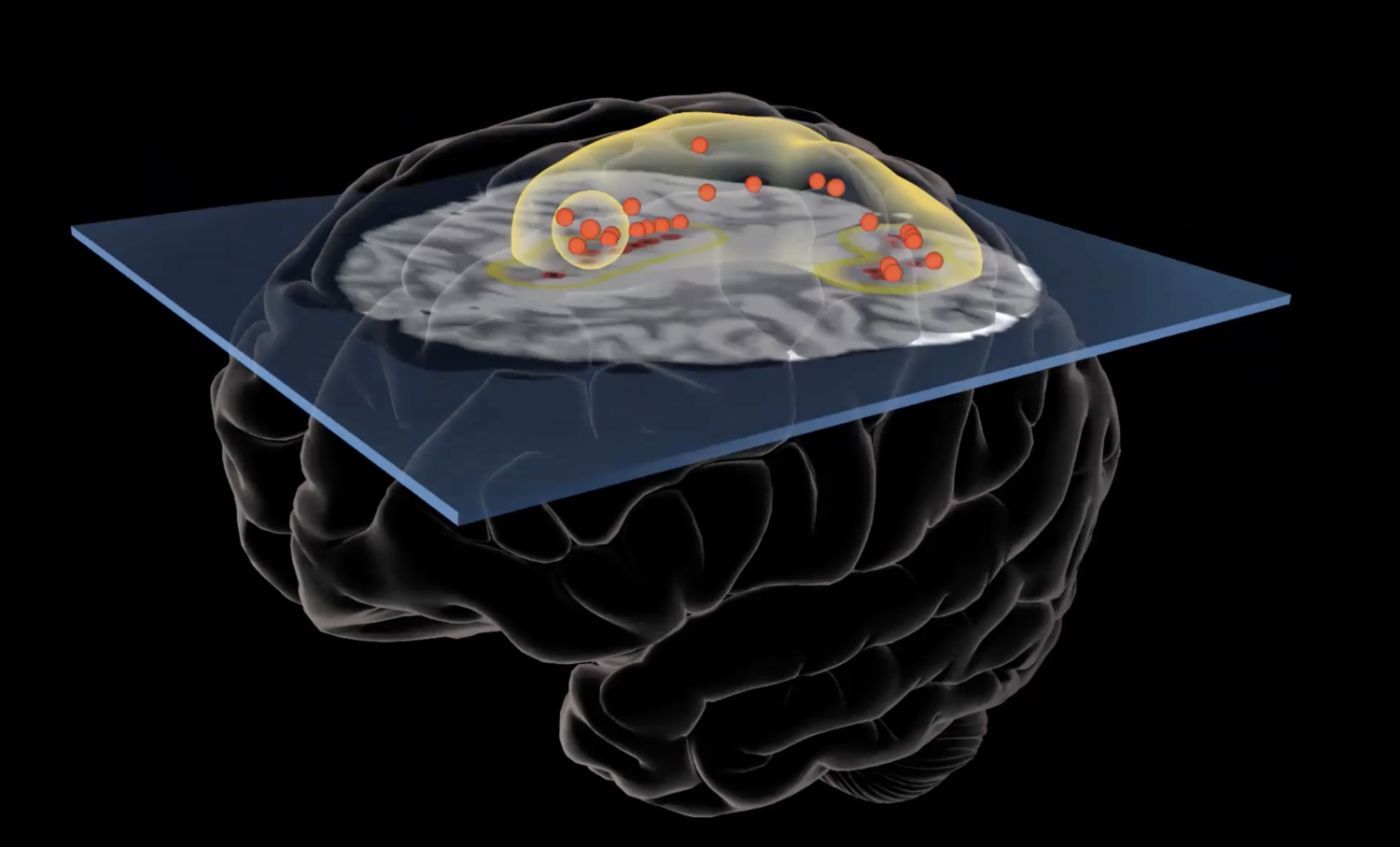 Neuron Injury – Medmovie.com