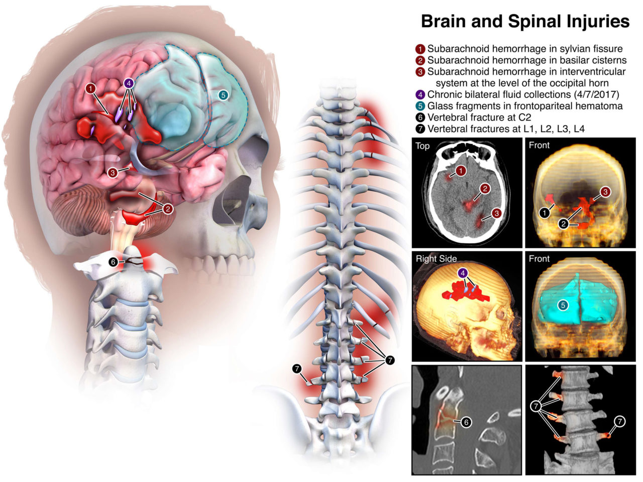 Summary of Brain and Spinal Injury – Medmovie.com