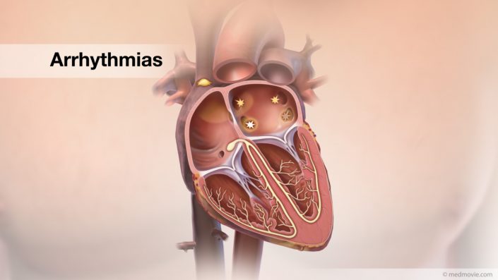 Balloon Atrial Septostomy (Rashkind) – Baby