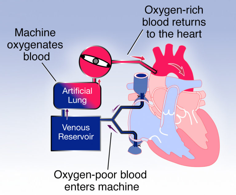 Heart Lung Bypass