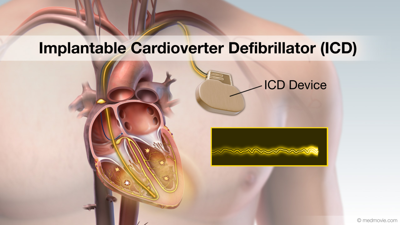 3D Electrical Mapping Of The Heart 3D Electrical Mapping Of The Heart