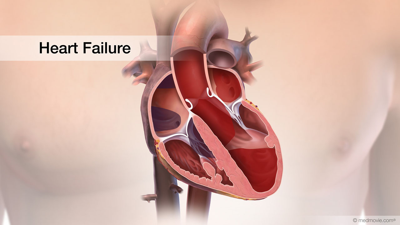 Ventricular Assist Device