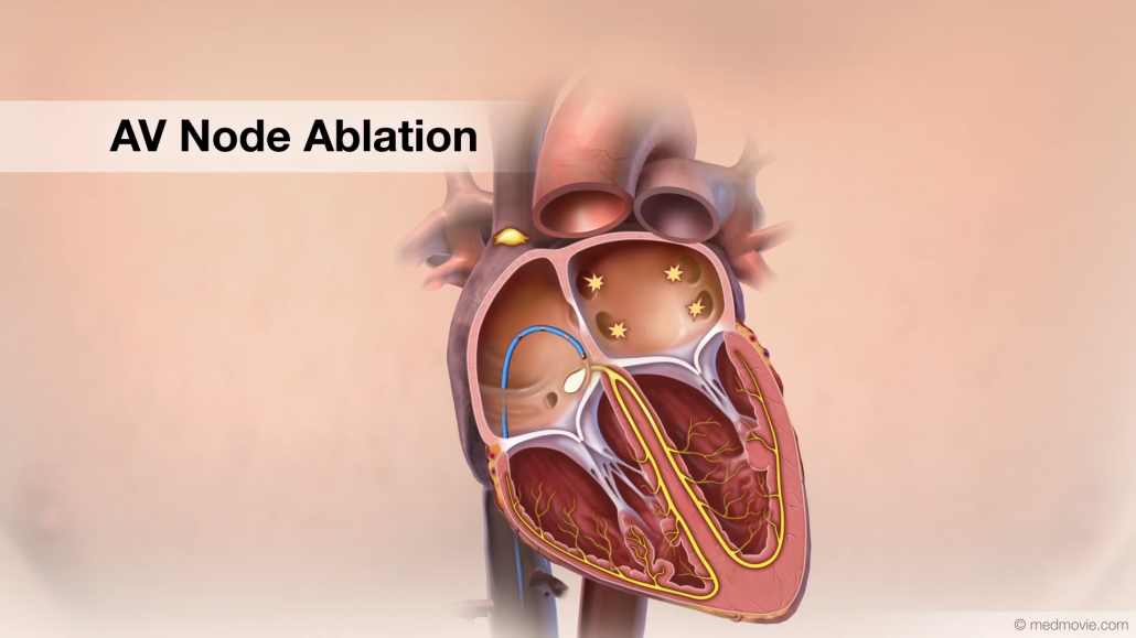 Balloon Atrial Septostomy (Rashkind) – Baby