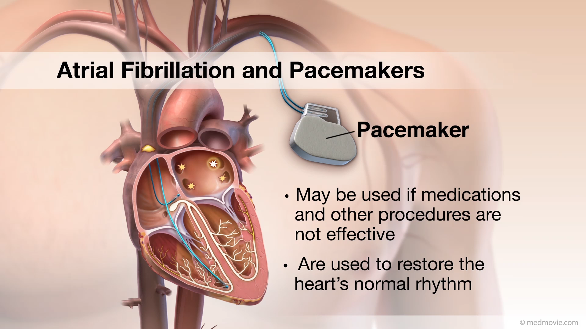 3D Electrical Mapping Of The Heart