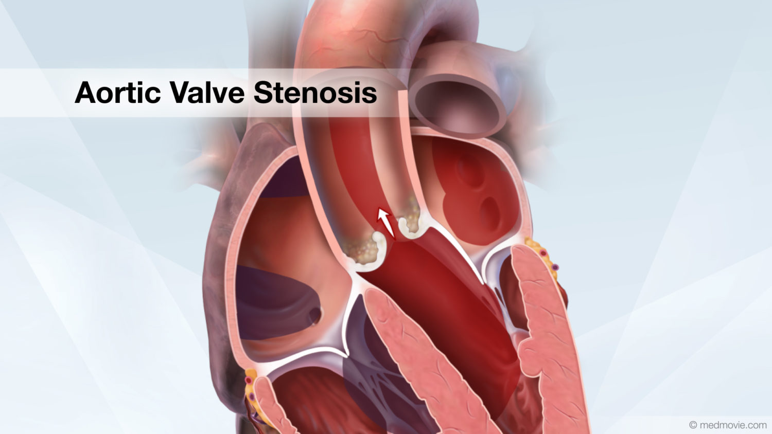 Balloon Atrial Septostomy (Rashkind) – Baby