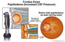 Papilledema Seen on a Fundus Exam – Medmovie.com