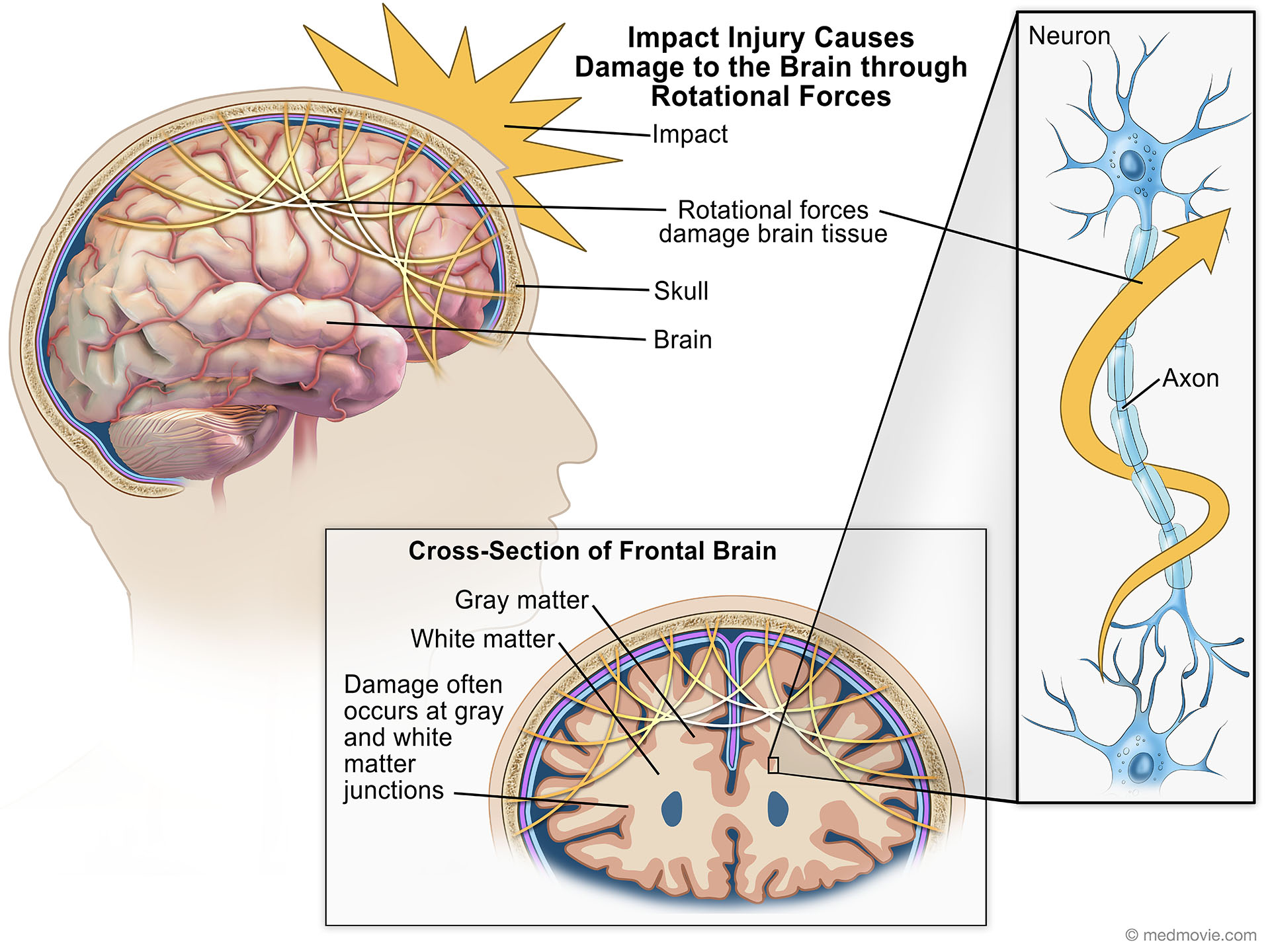 Brain Damage Caused by Impact Injury – Medmovie.com