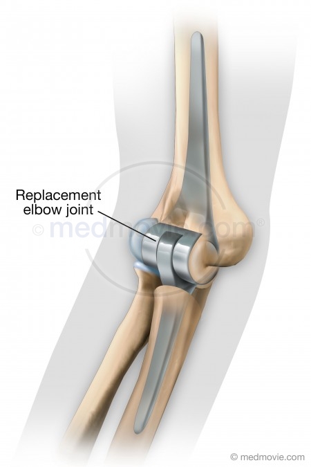 Elbow Joint Replacement – Medmovie.com